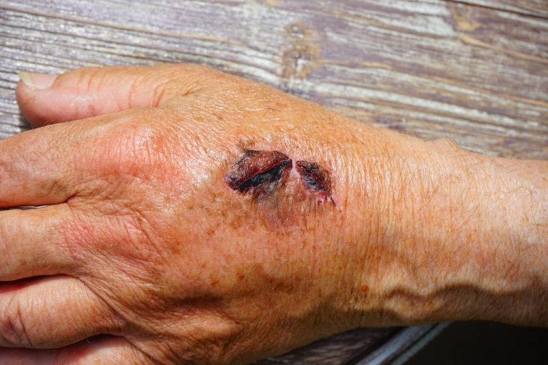 skin-lesion-scab-drug-abuse-1331740 - More Than Rehab