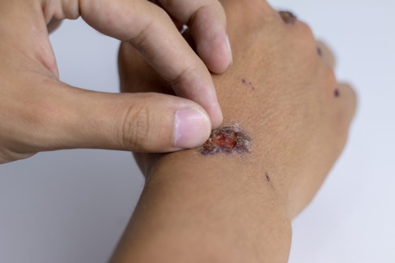Recognizing the Signs: How Drug Use Leads to Skin Wounds & Infections ...